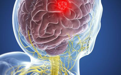 Todo lo que necesita saber sobre el cáncer de cerebro - Tratamiento ...