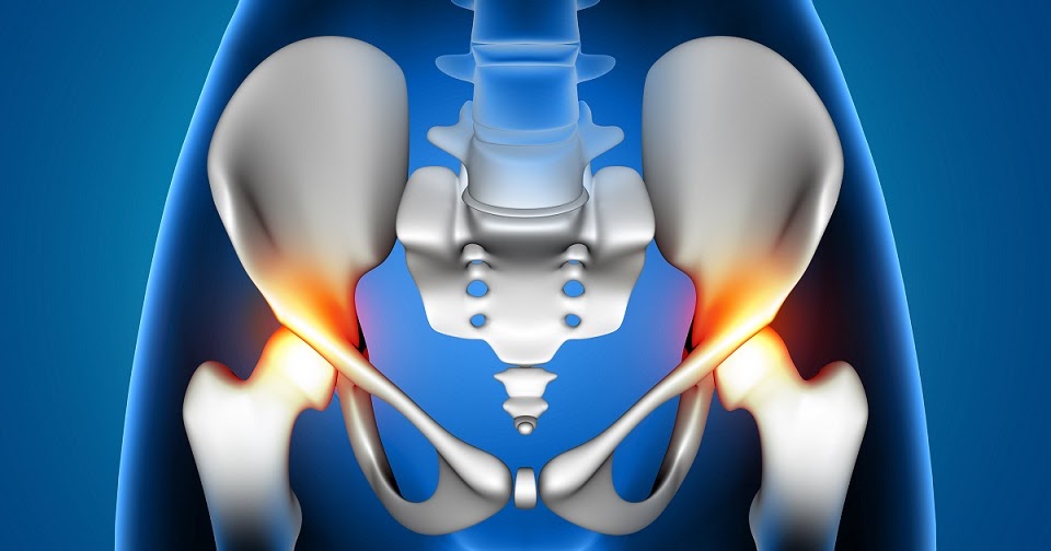 Reemplazo de cadera - Salud en línea