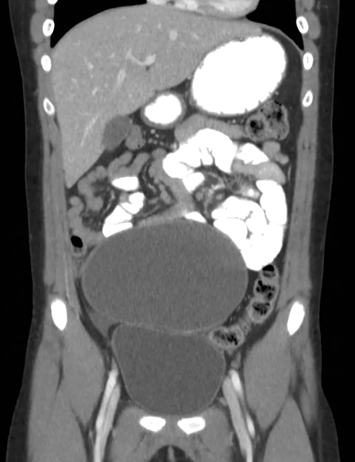 Klinik Dr Zaharuddin KL Gynaecologist: SISTA OVARI (OVARIAN CYST)