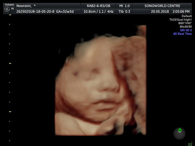 Scan 5D adik baby di Klinik My Family