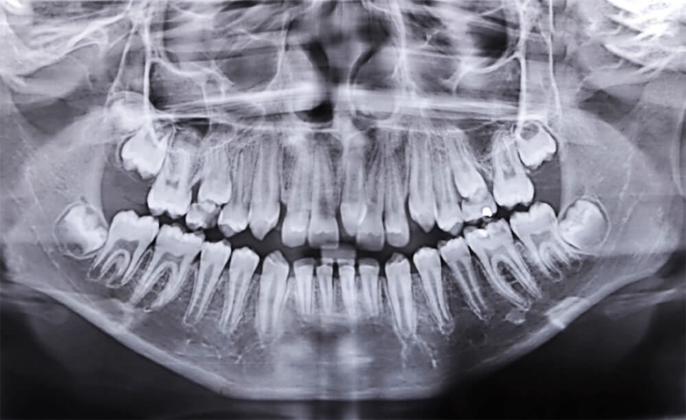 MESIODENS. CARACTERISTICAS.