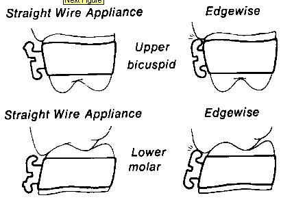 The Concept of the Straight Wire Appliance in Orthodontics