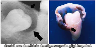 Mengenal Gigi Impaksi : Apa, Mengapa dan Bagaimana
