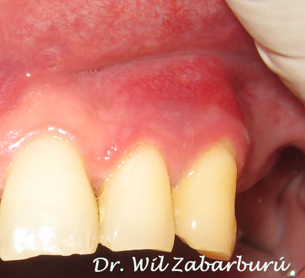 CLINICA DENTAL ASISTENCIAL: NEVUS FLAMMEUS