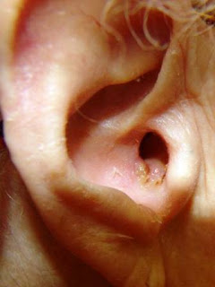 Daftar Obat Paling Aman Ter-up-to-date: Pengobatan Otitis atau Radang ...