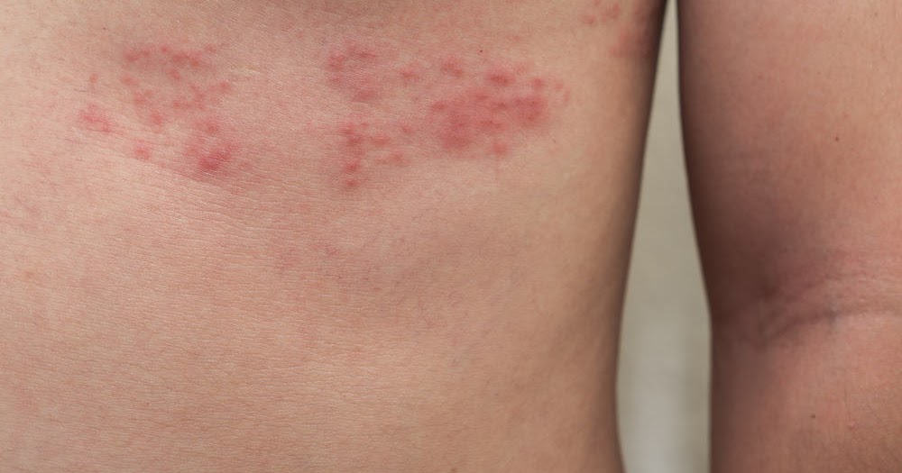 Kisah Terkena Cacar Ular (Herpes Zoster) | Grandysofia | Blog Travel ...