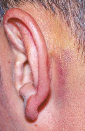 Battle sign / Battle's sign