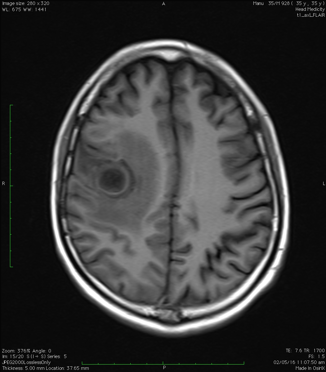 Ultimate Radiology Frontal Lobe Abscess Follow Up MRI ultimate-radiology-frontal-lobe-abscess-follow-up-mri