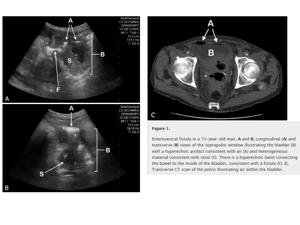 BÀI SOẠN VỀ SIÊU ÂM CHẨN ĐOÁN: Enterovesical Fistula: Sonographic Diagnosis