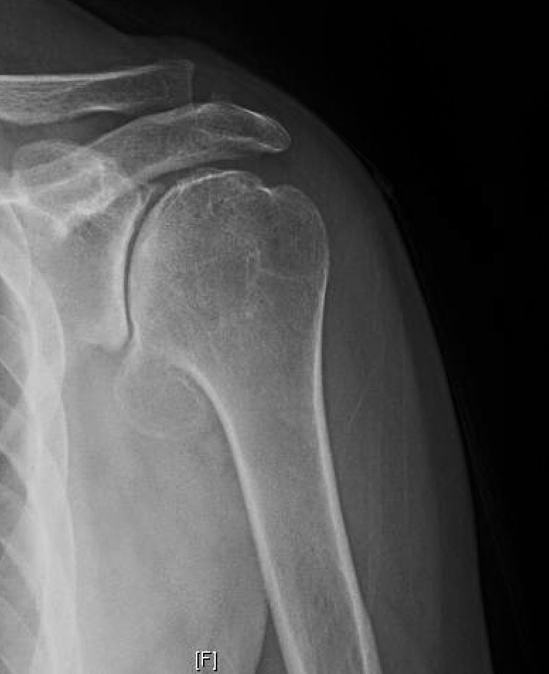 Shoulder Arthritis / Rotator Cuff Tears / Shoulder Pain : Severe B2 ...