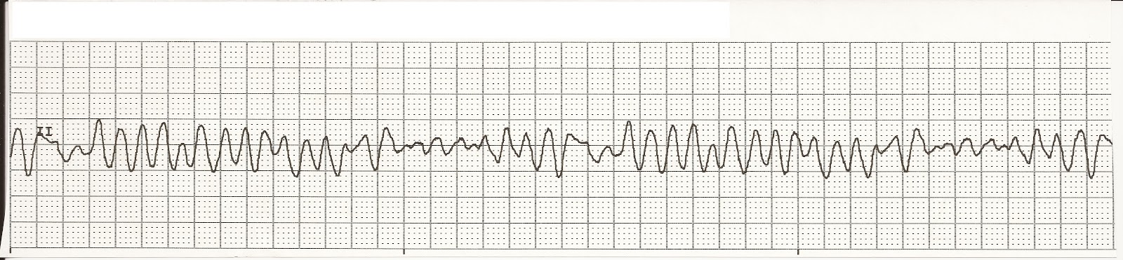 ACLS Rhythms: Ventricular rhythms