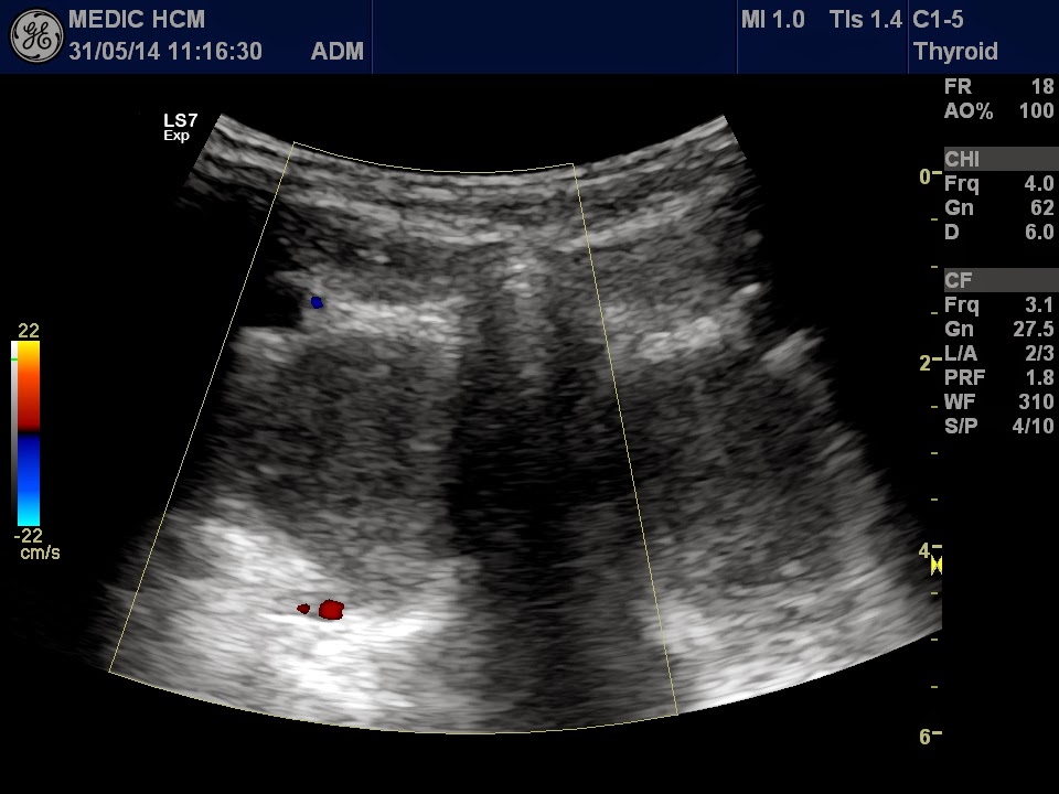 VIETNAMESE MEDIC ULTRASOUND: CASE 290: PARACERVICAL SPINE ABSCESS: Dr ...