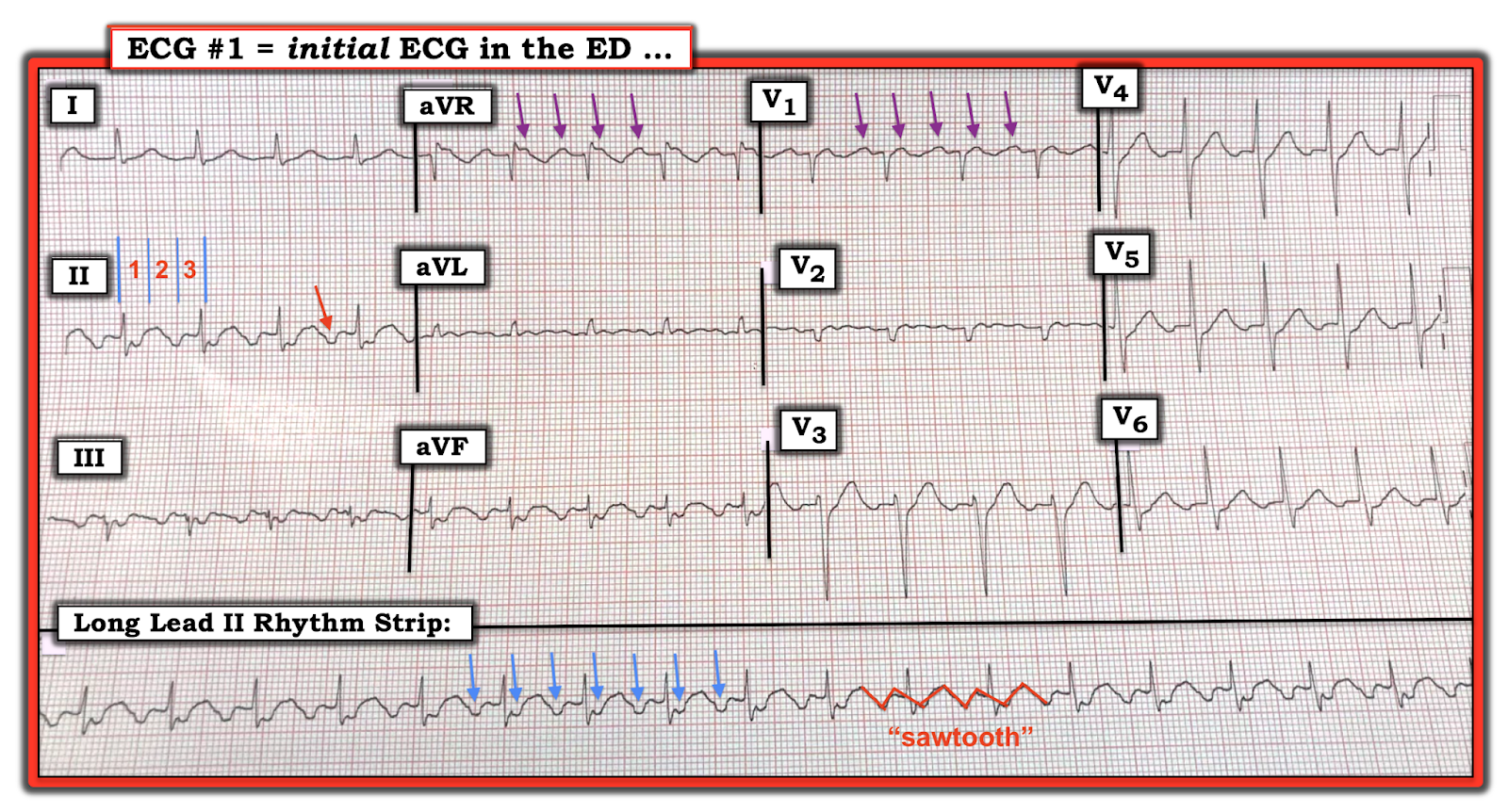 Dr. Smith's ECG Blog: Global ST depression with ST elevation in aVR ...