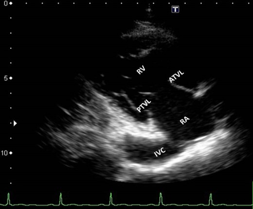 CVT Mohd Farid: Basic Echocardiography:Transthoracic Echocardiography ...