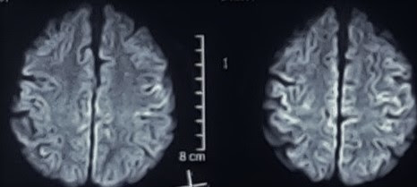 Hypoxic Ischemic Brain Injury - Sumer's Radiology Blog
