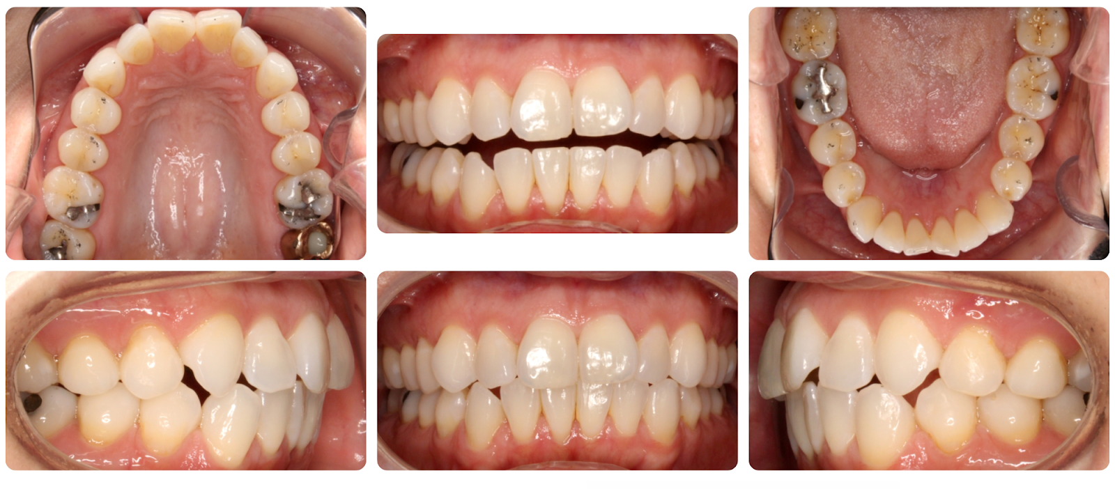 Sneek's Invisalign Treatment: My Progress