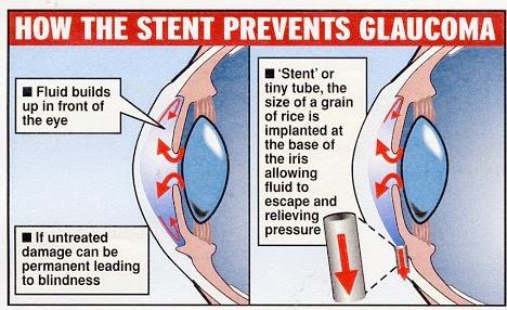 Stents for Glaucoma Treatment