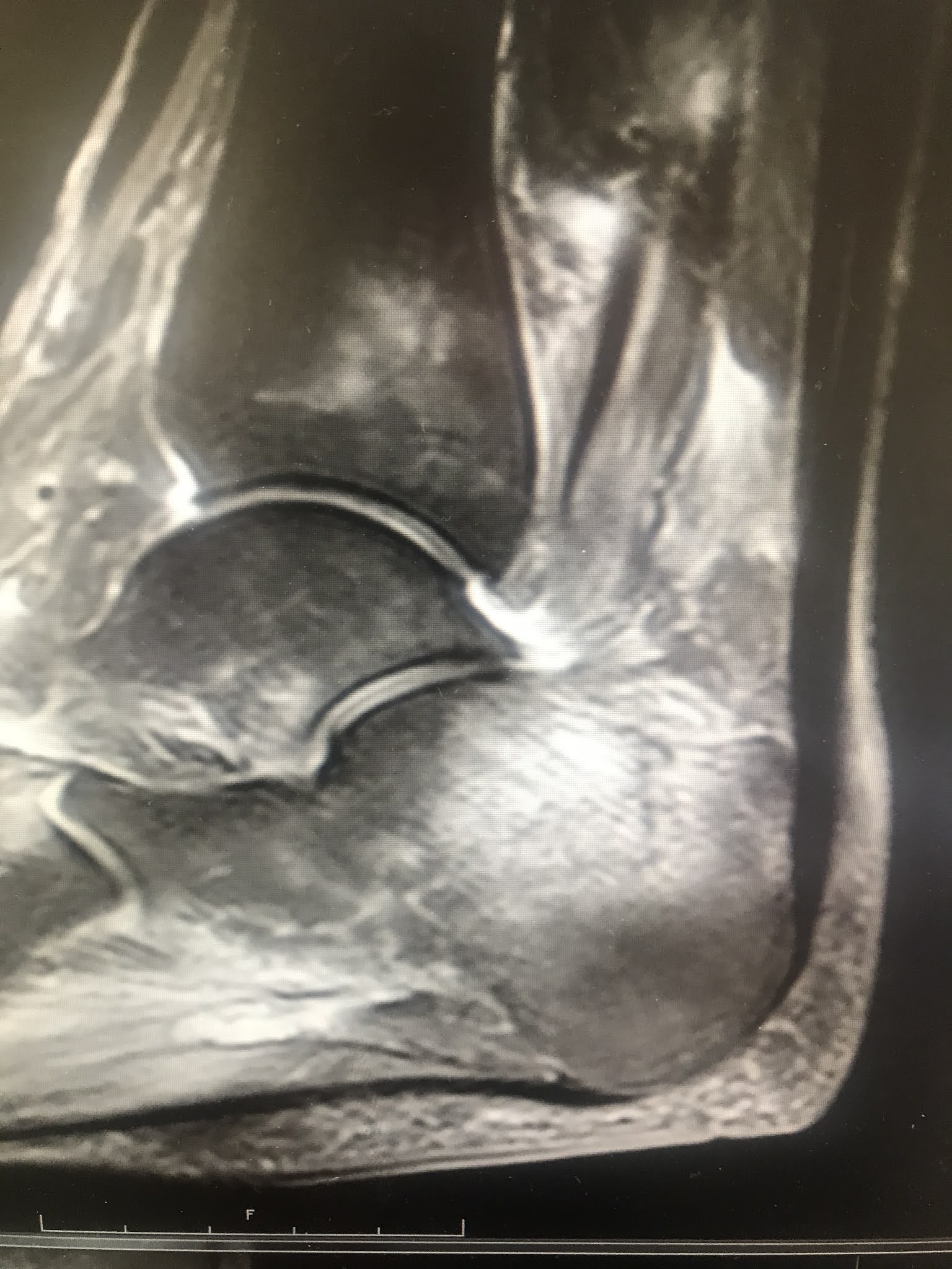 Foot and Ankle Problems By Dr. Richard Blake: Heel Stress Fracture: But ...