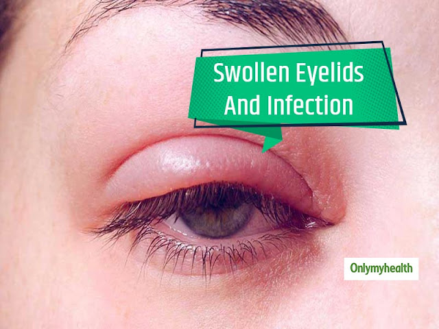 Swollen Eyelid — Causes, Treatment, and More