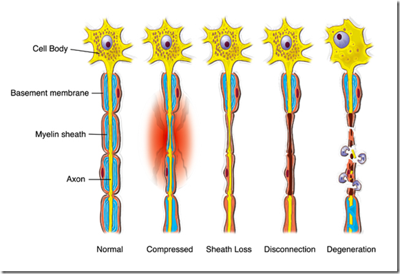 Damaged Small Nerves Lead To Damaged Longer Nerves | Neuropathy and HIV