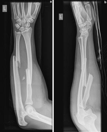 Ulna Fracture Treatment | Ulna Bone Fracture Surgery