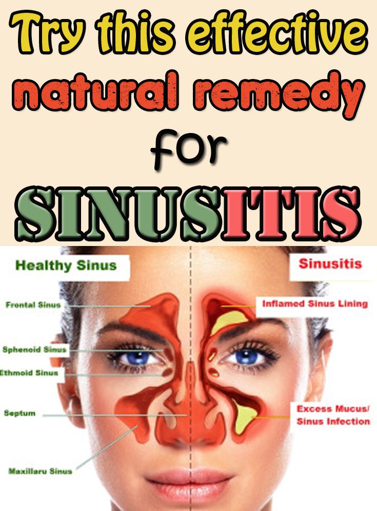 Natural Method To Treat Sinusitis - precious health