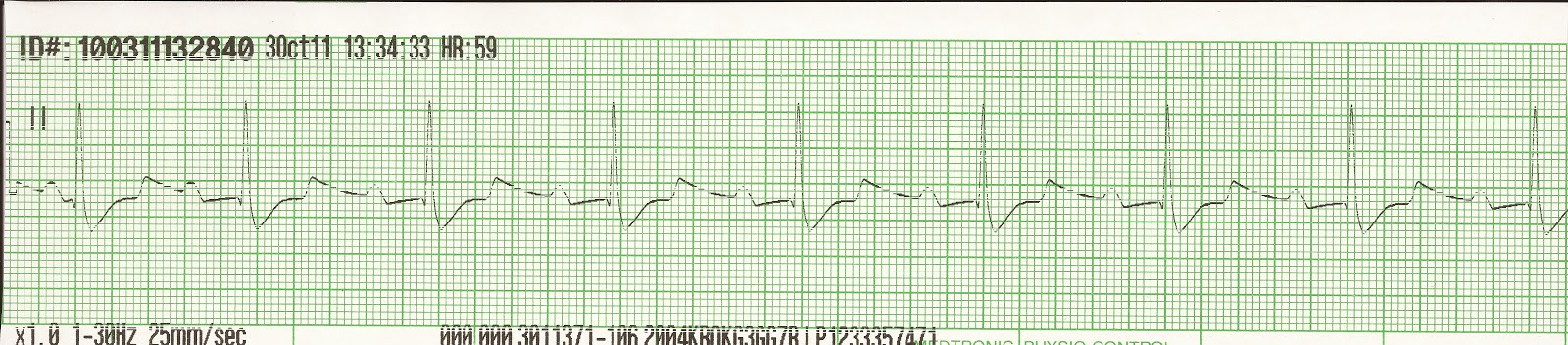 ACLS Rhythms: Heart blocks