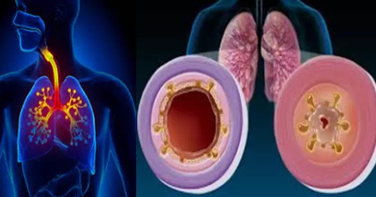 Perbedaan Bronkitis dan Bronkiektasis - Brankaspedia - Blog tutorial ...