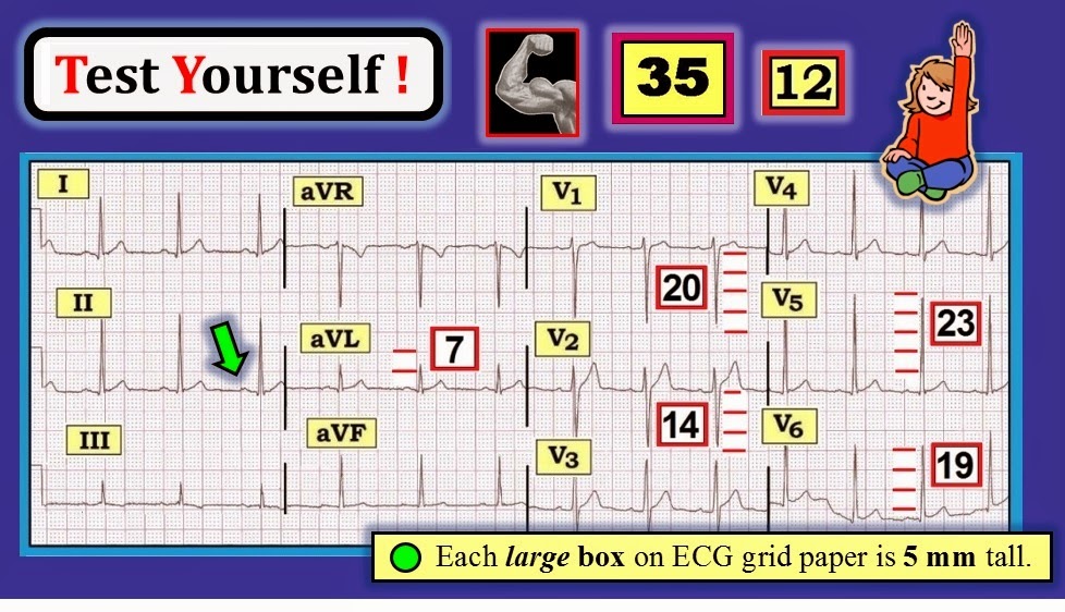 ECG Interpretation: ECG Blog #92 (Basic Concepts-5) – LVH