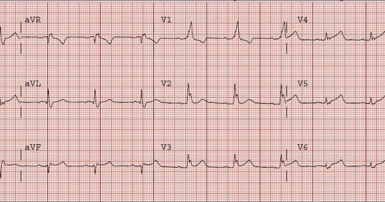 Dr. Smith's ECG Blog: Right Bundle Branch Block (RBBB) with ...