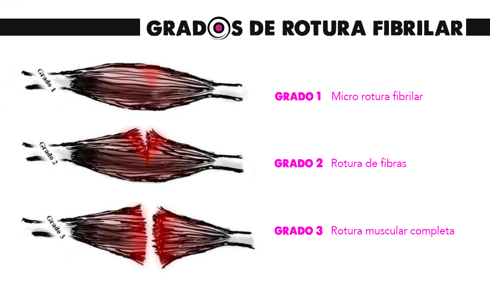 Kms x Hacer: ROTURA FIBRILAR