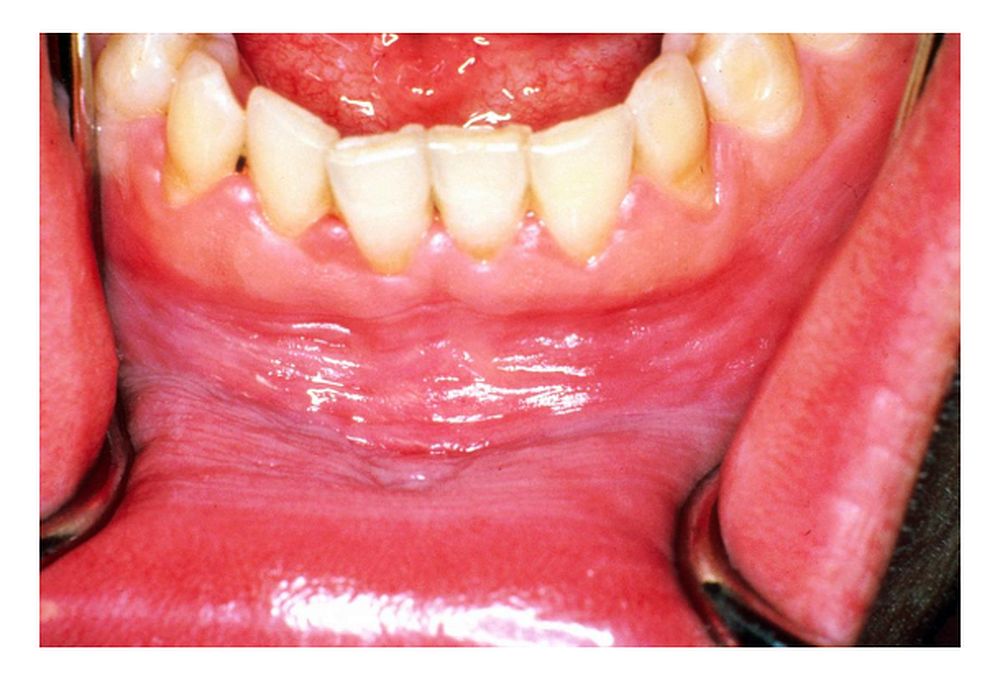 What Does It Mean When You Have White Gums what-does-it-mean-when-you-have-white-gums
