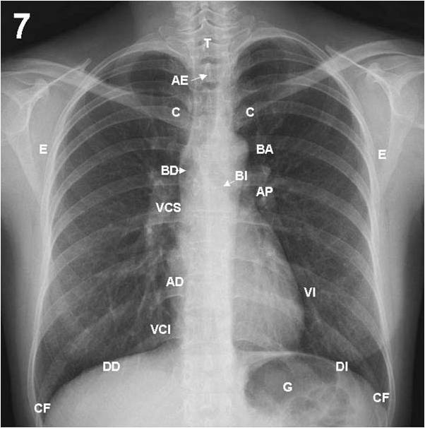 Medicina I UNNE: RADIOGRAFÍA DE TÓRAX