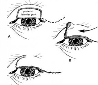 Eyelid Surgery by Prof Dr CN CHUA 蔡鐘能: Ways of Repairing Lost Upper Eyelid