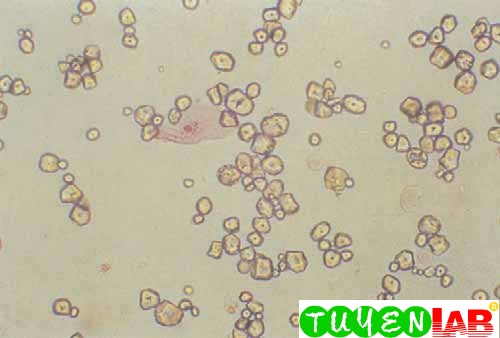 Atlas of Miscellaneous images in urine | Free Medical Atlas