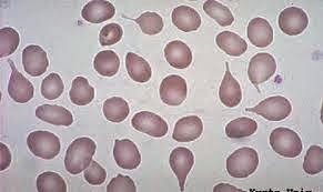 HEMATOLOGIA: DACRIOCITOS