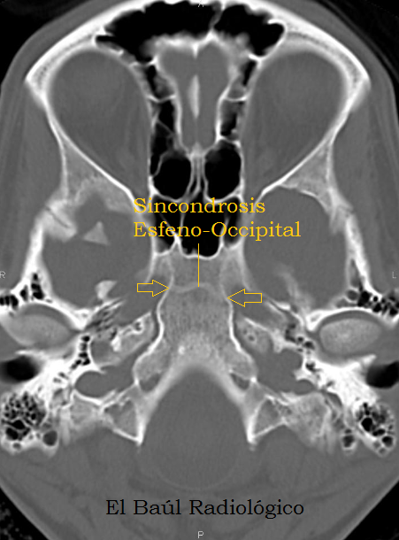 El Baúl Radiológico: SINCONDROSIS ESFENOBASILAR. (Sphenobasilar ...