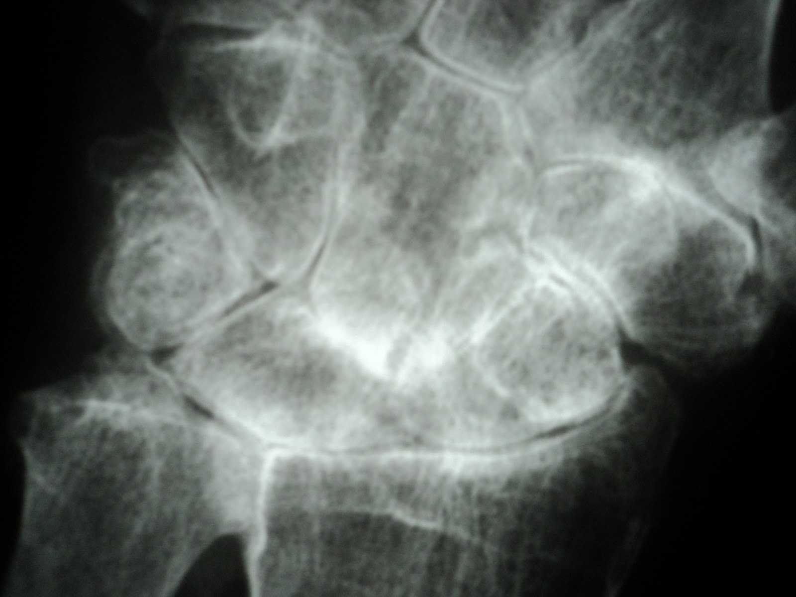 OSSA CARPALIA ©: Patomecánica de la mano reumática.