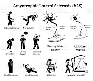 ALS Disease and Treatment