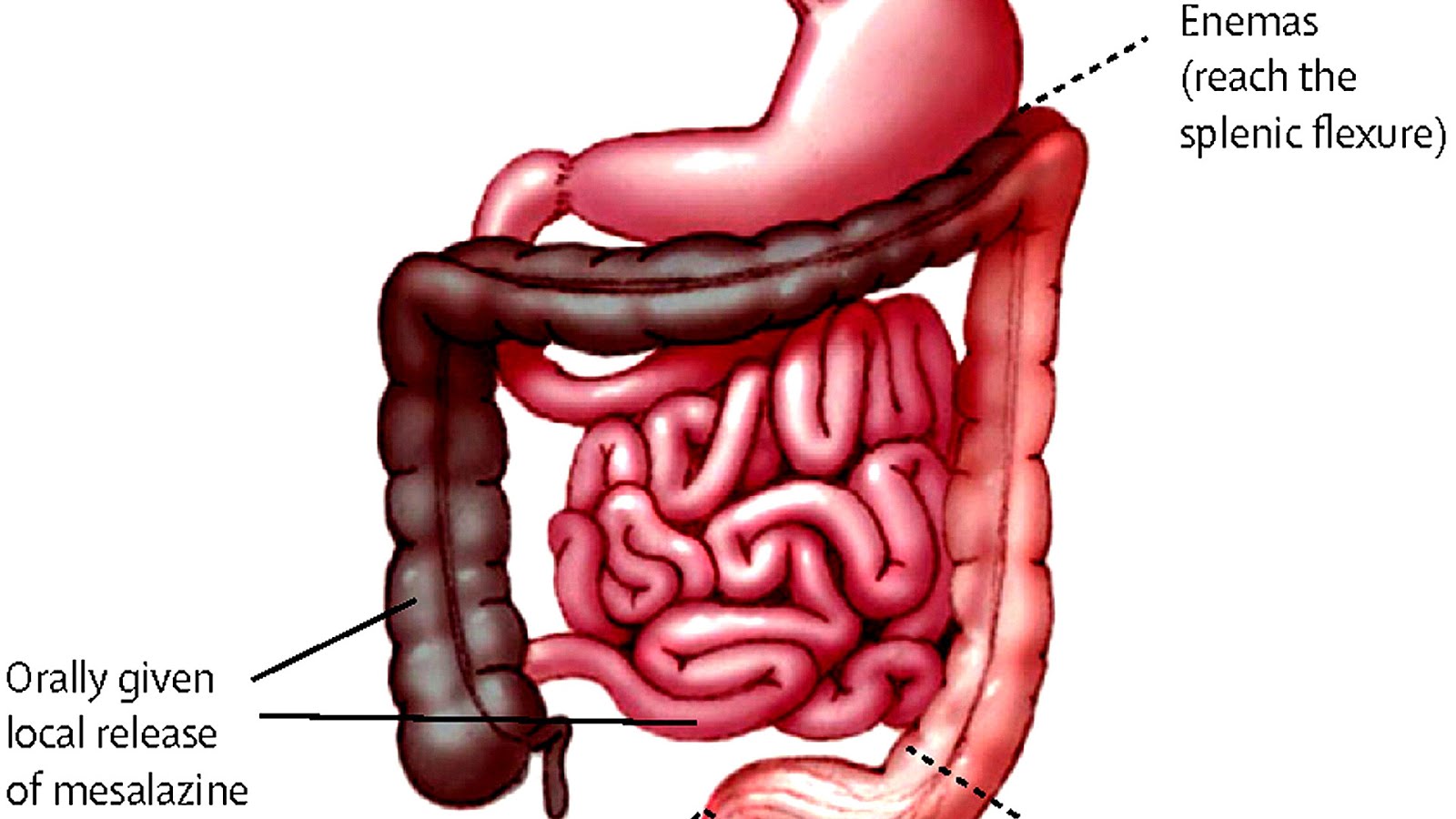 Can Ulcerative Colitis Turn Into Cancer - Ulcer Choices
