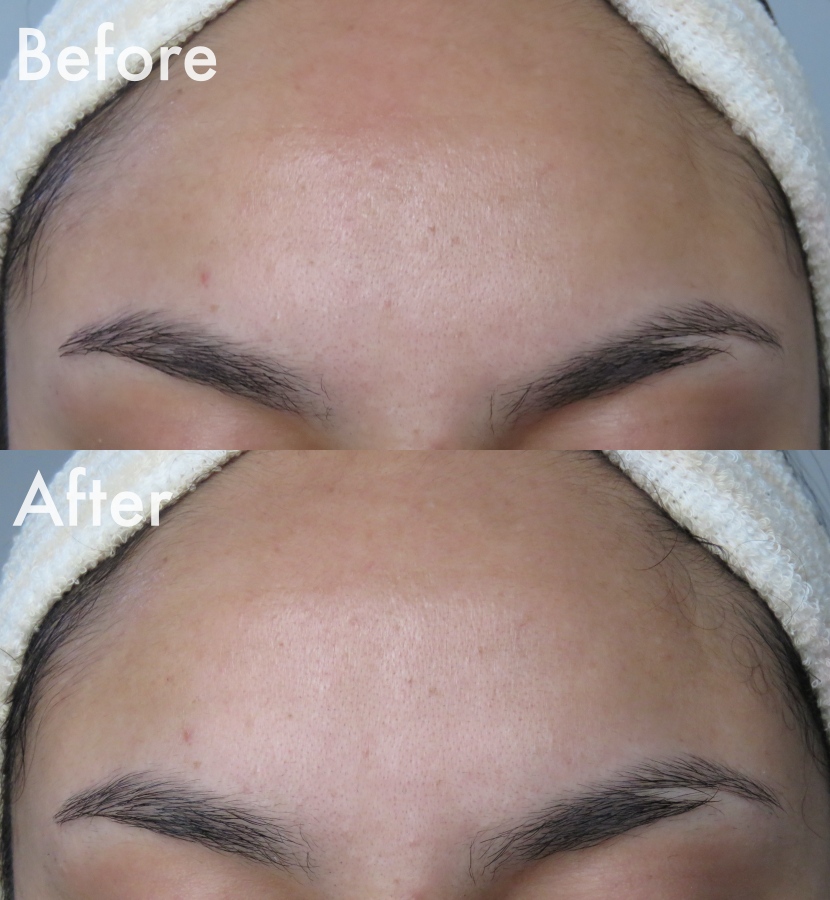 Review: The Ordinary Peeling Solution AHA 30% BHA 2% | My Wonderland