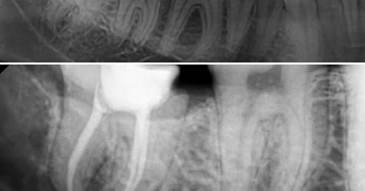 Dental Dreamz: Impacted Third Molar Root Canal Treatment.