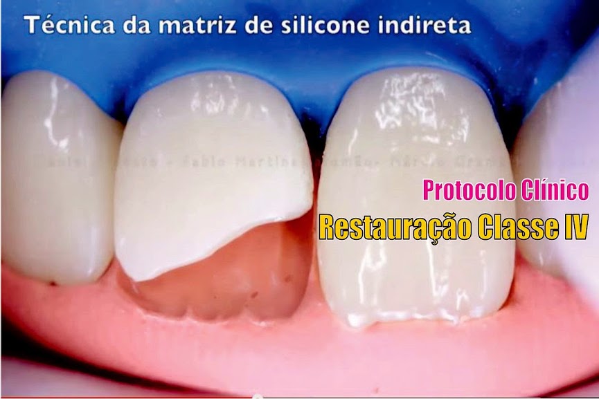 RESINA COMPOSTA: Restauração Classe IV Passo a Passo - Caso Clínico ...