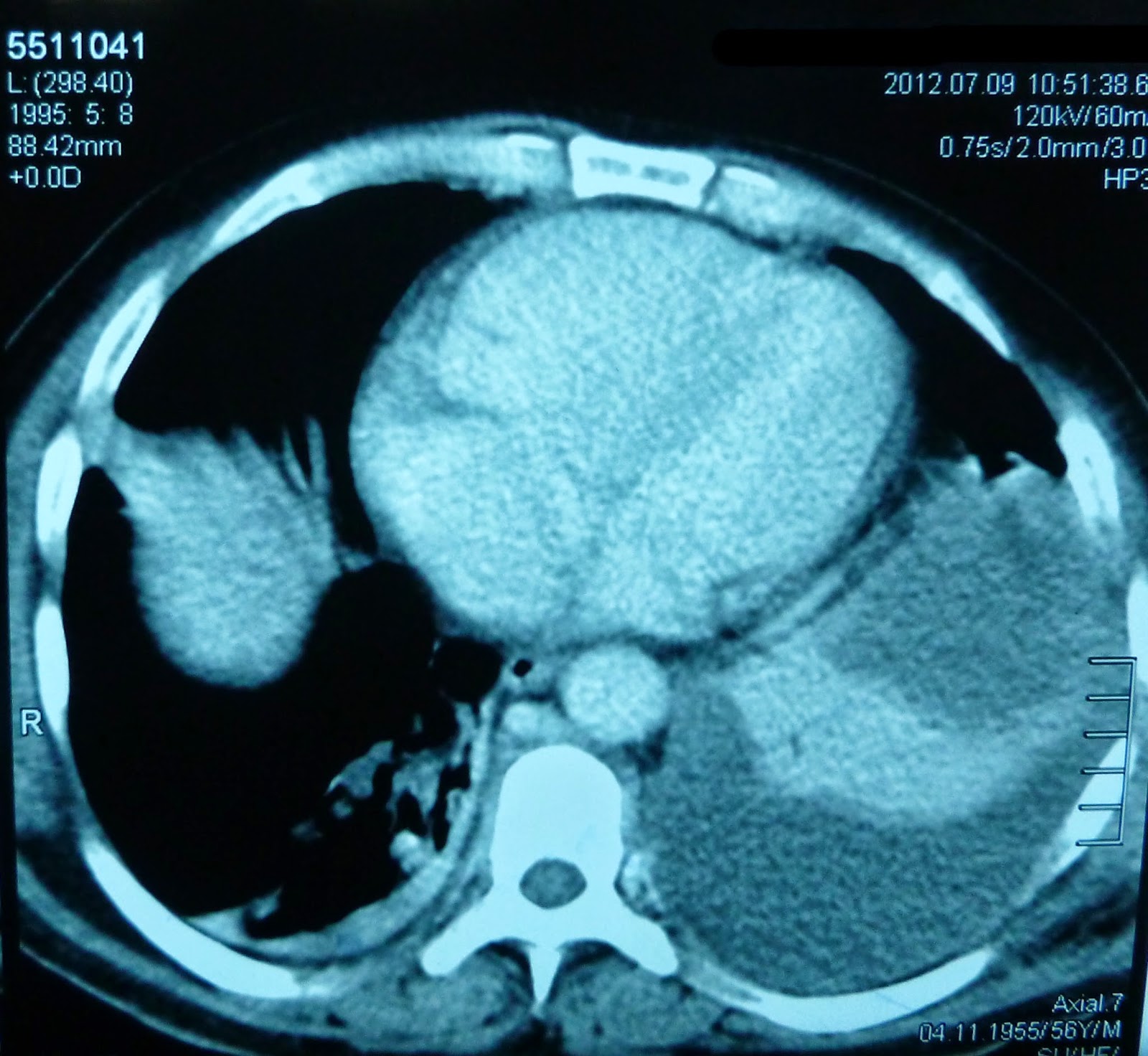 Revision Casos De Cirugia General: SIGNO DE GREY TURNER