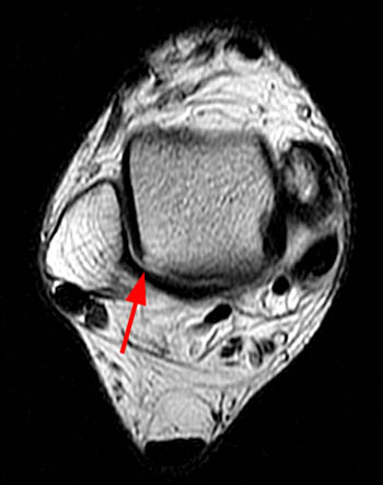 MRI Musculo-Skeletal Section: High ankle sprains.