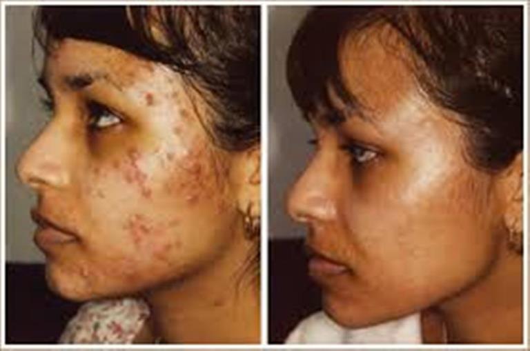 Namna ya kutibu chunusi kwa kutumia Binzari, maziwa na asali - Afya Yako