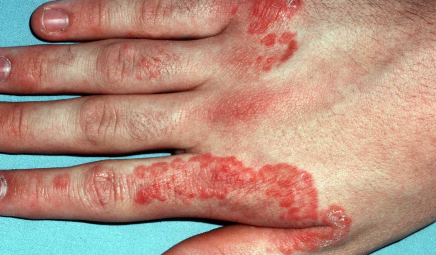 Tinea Manuum Nedir? Nedenleri, Belirtileri, Tanısı ve Tedavisi