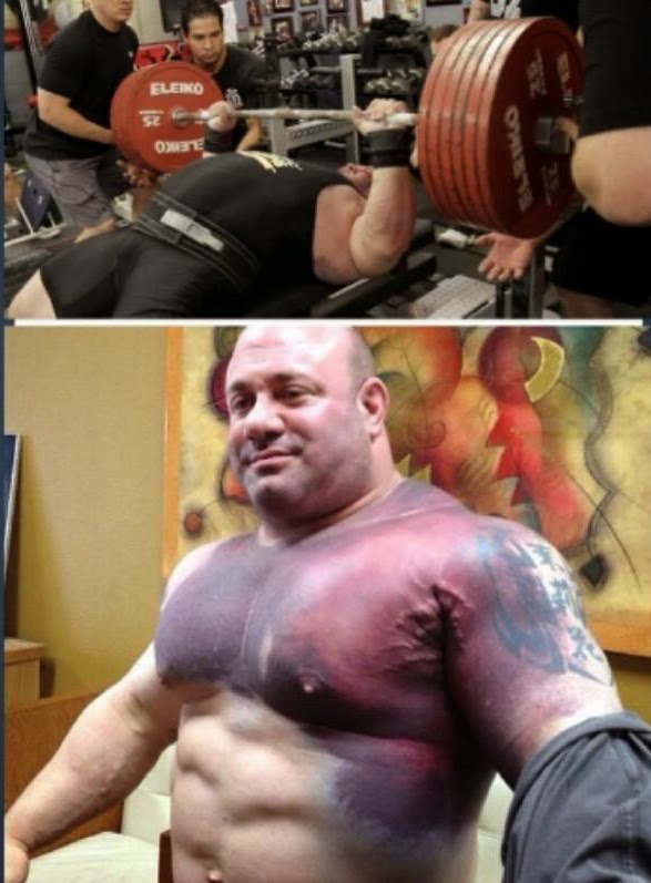 Scott Mendelson after his Chest Injury | Bodybuilding and Fitness Zone