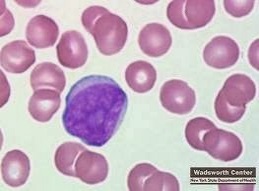 Blog del Laboratorio clinico : Monoblasto