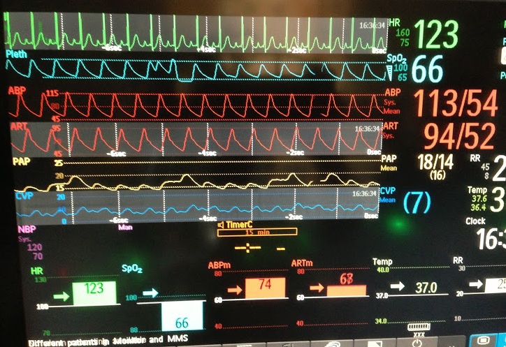 Pedi cardiology: ICU Monitor: Freeze Frame Function to analyze traces